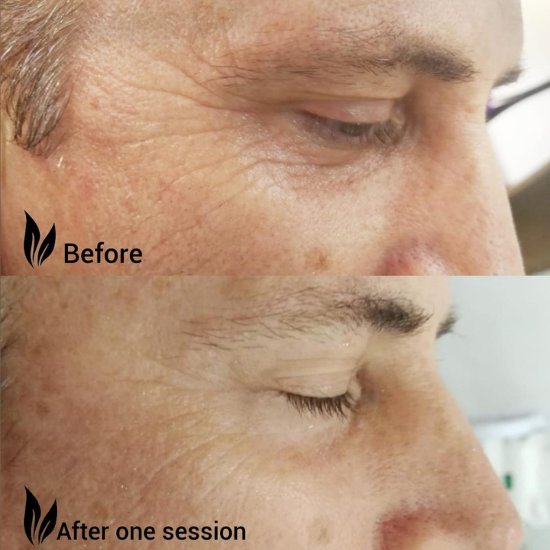 PLEXR Plasma Pen – Laser Elite